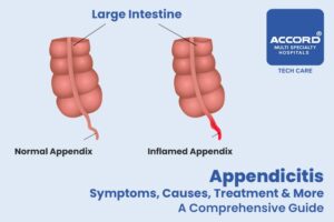 Appendicitis: Symptoms, Causes, Treatment, and More – A Comprehensive Guide - Accord Hospitals ...